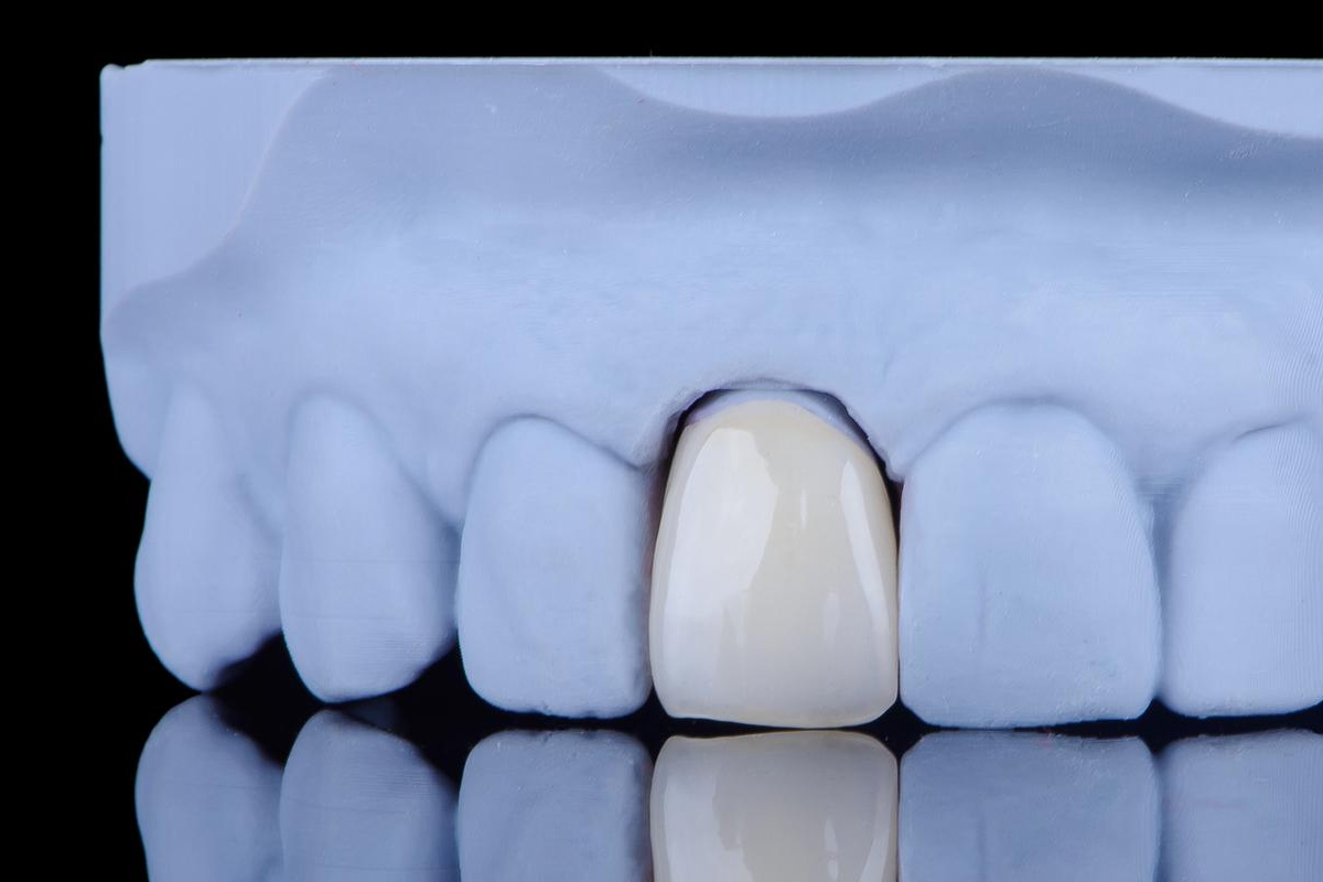 What Are Removable Dental Bridges?