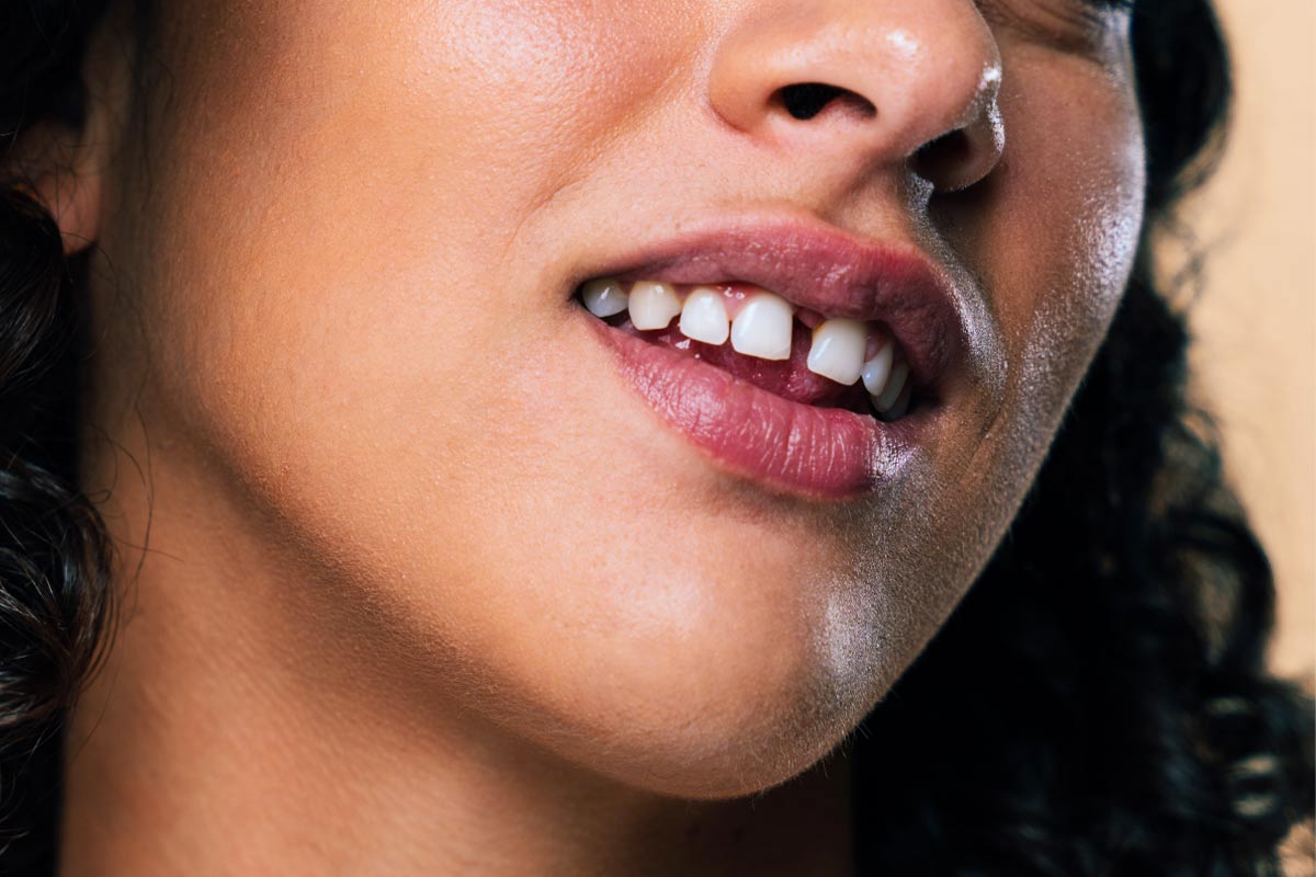 Can Teeth Gaps Be Closed With a Composite Filling?