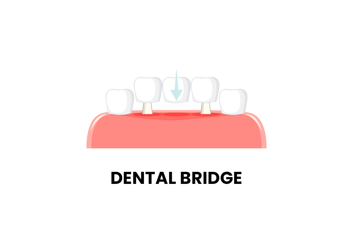 Is There a Dental Bridge for One Tooth?