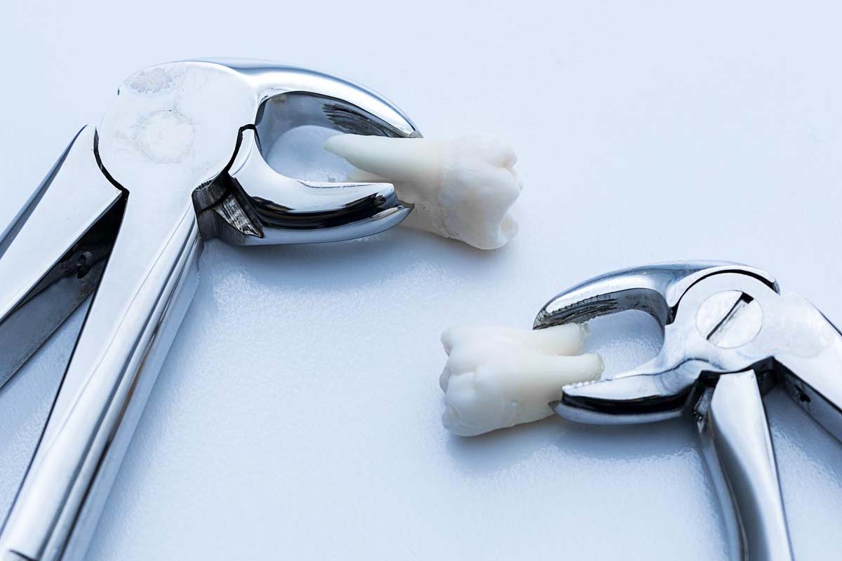 Tooth Extraction in Seattle, WA | Kirkland Dental Excellence