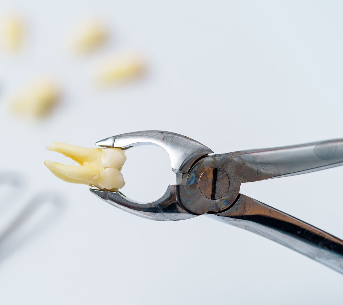 Wisdom Teeth Removal in Seattle, WA | Kirkland Dental Excellence