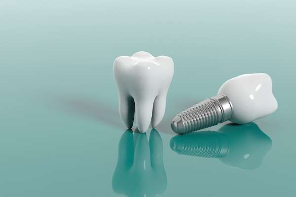 Multiple Teeth Replacement Options: One Implant for Two Teeth Multiple Teeth Replacement Options: One Implant for Two Teeth